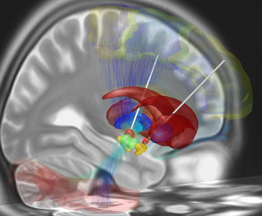 Deep Brain Stimulation – PennNeuroKnow