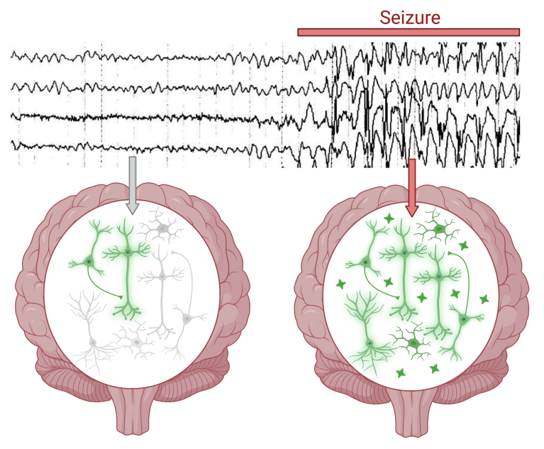 What is a seizure? – PennNeuroKnow