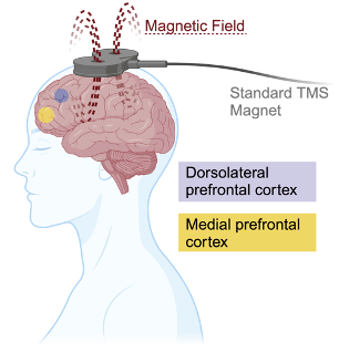 Magnetic manipulation of brain activity to treat mental illness ...
